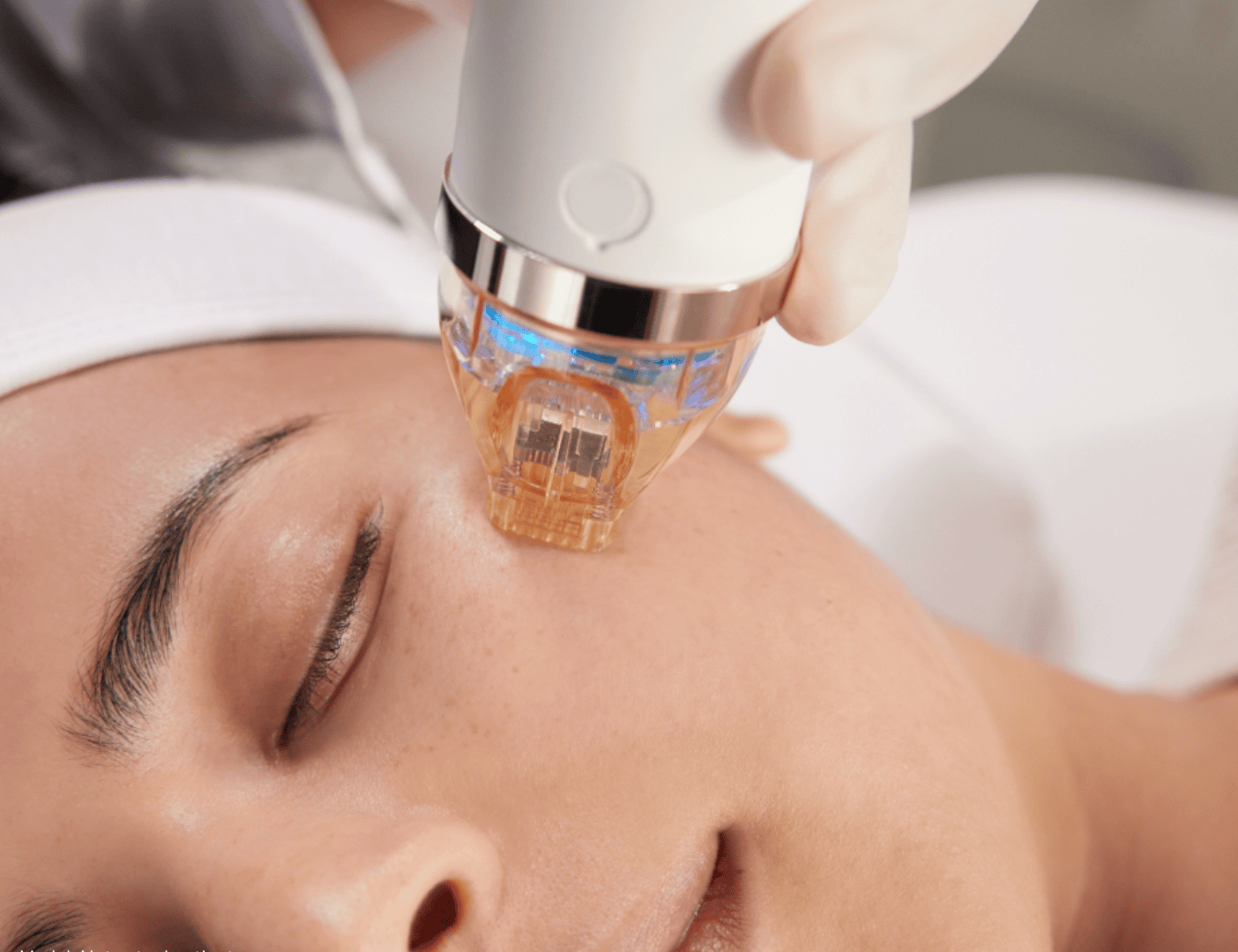 Secret RF® Radiofrequenz Microneedling – Biljanas Secret of Beauty